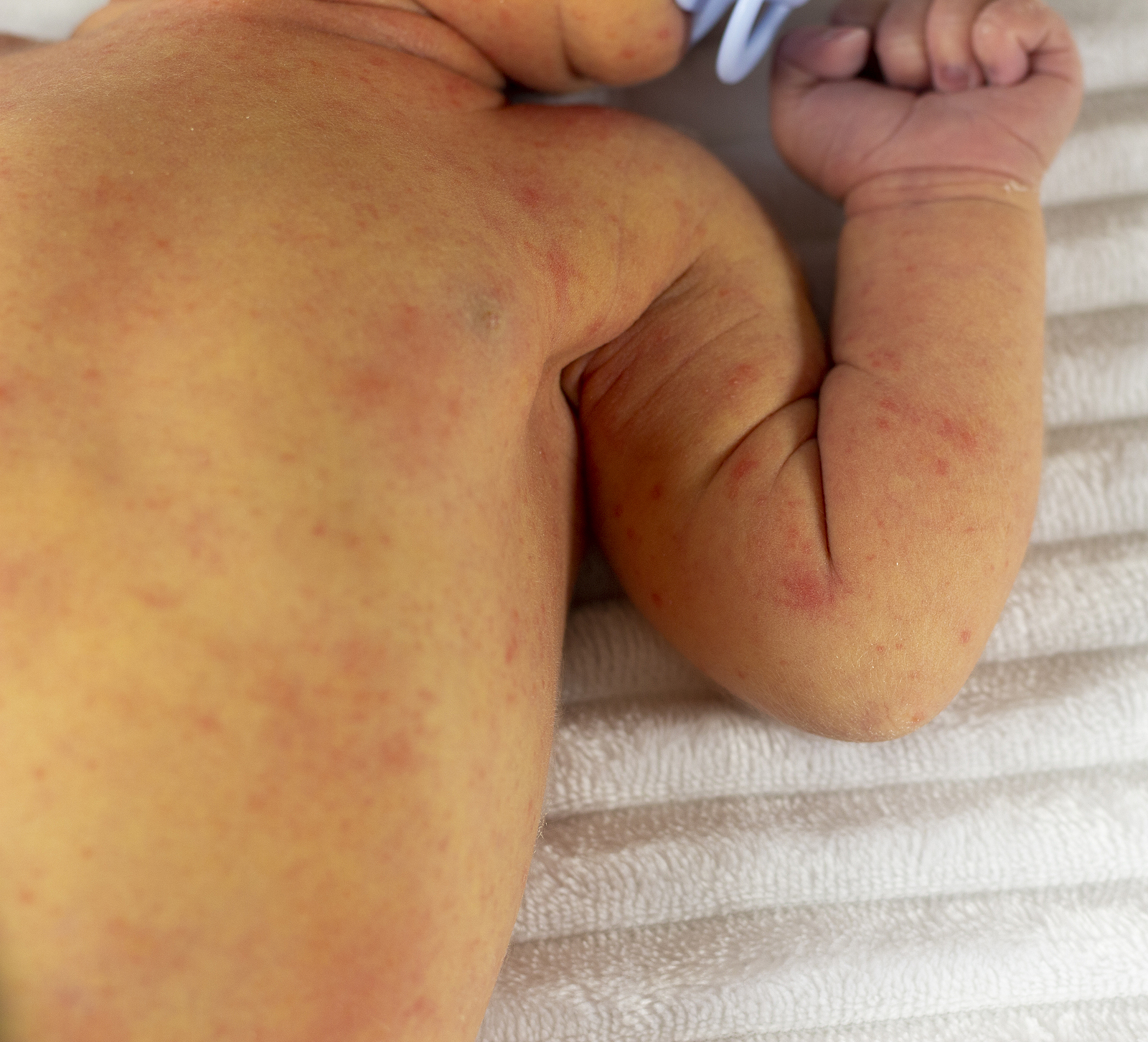 Pediatric Home Care Tips For Treating Infant Jaundice Suma Home Care pediatric-home-care-tips-for-treating-infant-jaundice-suma-home-care